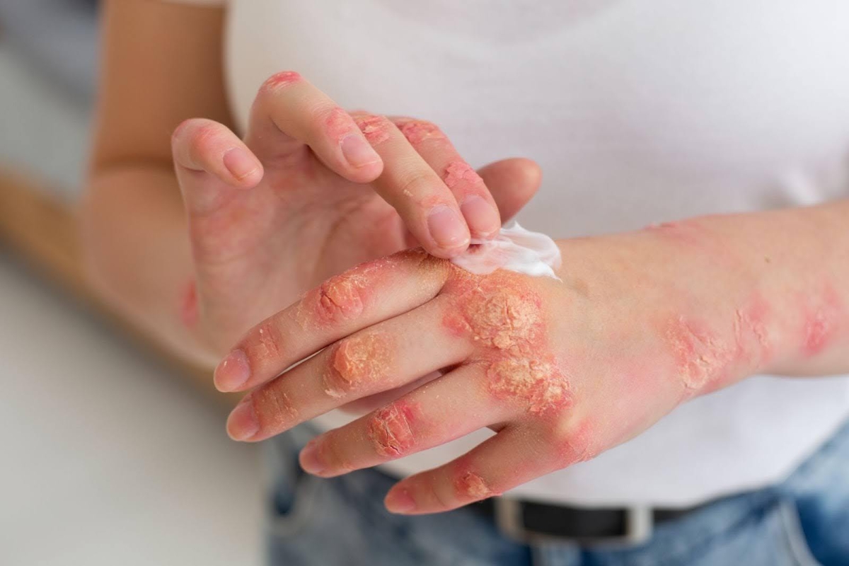 Warts: Causes & Best Wart Remover Solutions That Work